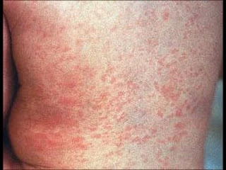 Prepare for Medical Exams : Roseola Infantum