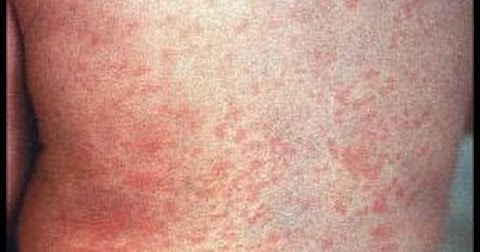 Prepare for Medical Exams : Roseola Infantum