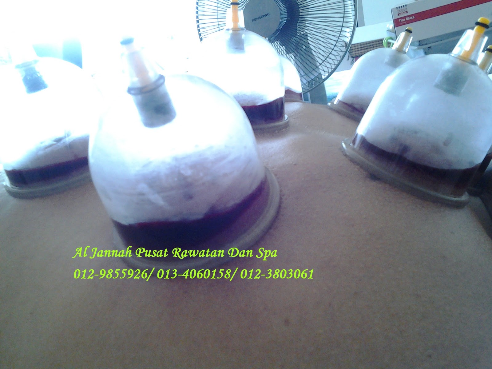 AL JANNAH PUSAT RAWATAN BEKAM DAN AKUPUNTUR KELANTAN: gambar-gambar ...