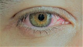 Alergi pada Mata dan Cara Mengatasinya