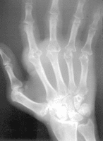 Back to Health Wellness Centre : Metacarpophalangeal Joint (MCP)