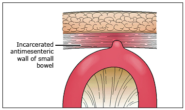 HERNIAS
