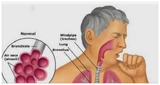 What is pneumonia? Symptoms and Prevention | HEATH CARE