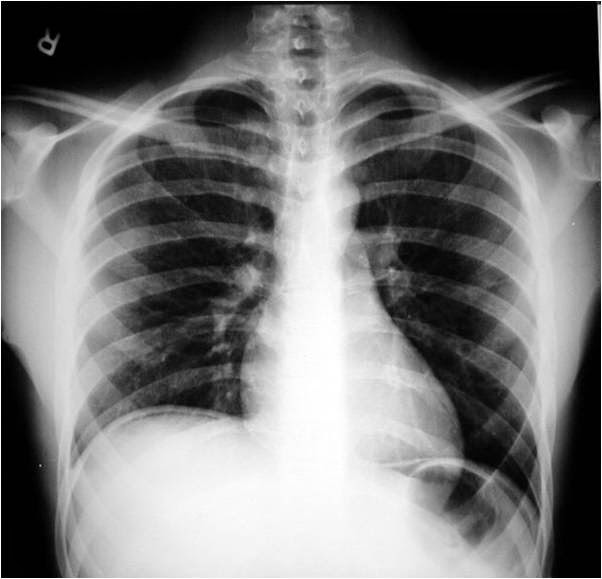 RADIOLOGY IMAGE SPOTTERS: Pneumoperitoneum