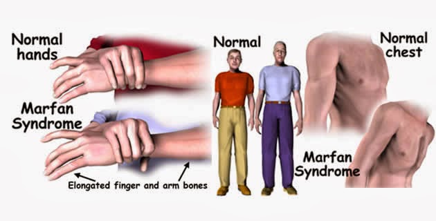 Medical Treatment Pictures-for Better Understanding: Marfan Syndrome