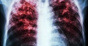 TIBI: Simptom dan Tips Merawat Dengan Cepat