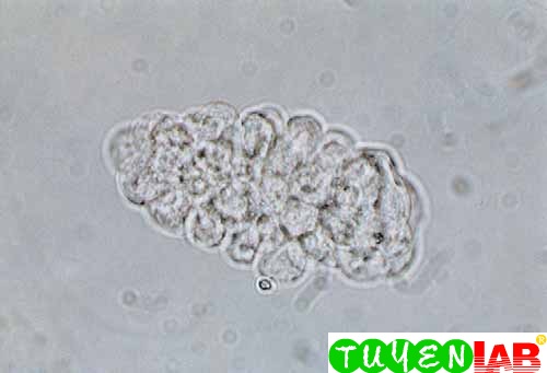 Atlas of Casts in urine | Free Medical Atlas