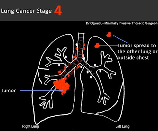 Lung Cancer: Lung Cancer Life Expectancy