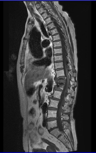 Plain MRI of the Thoracic and Lumbar Spine Junction - RadTechOnDuty Plain MRI of the Thoracic and Lumbar Spine Junction - RadTechOnDuty