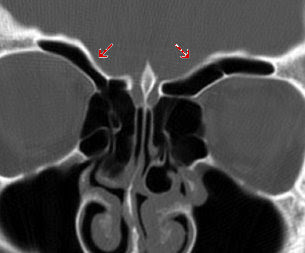 Tutorials in otolaryngology: Anatomy of anterior ethmoidal artery