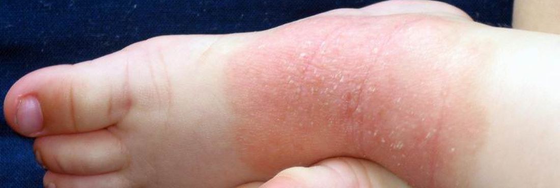 Dermatite - O Que É? Quais Os Tipos E Sintomas? Como Tratar?