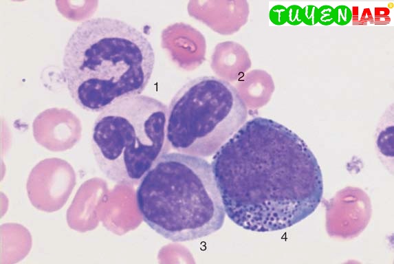 Immature Granulocytes High