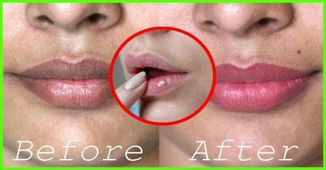 Home Remedies To Get Rid Of White Bumps On Lips TOP 5 DIY home-remedies-to-get-rid-of-white-bumps-on-lips-top-5-diy