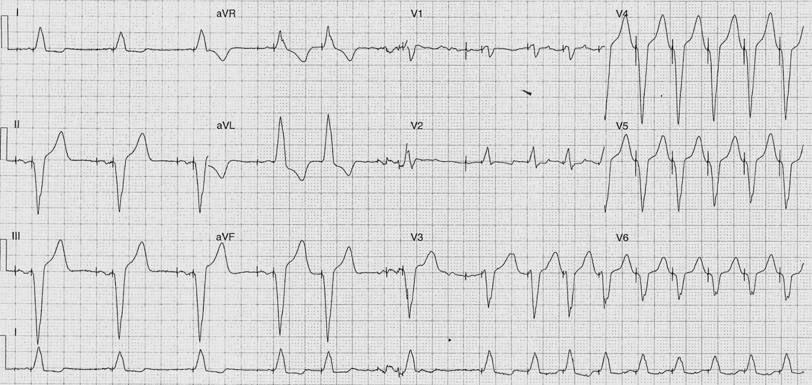 ECG of the Week: ECG of the Week - 1st September 2014 - Interpretation