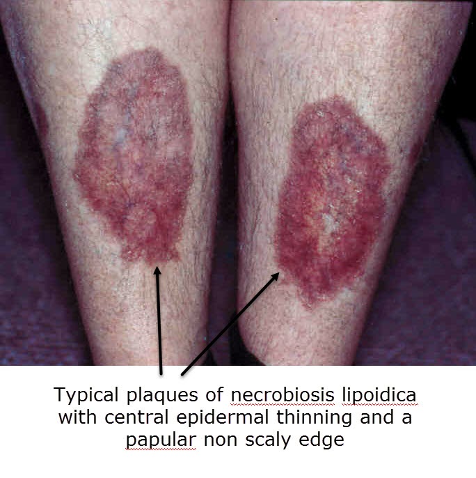 Dermatopathology Made Simple - Inflammatory: Granulomatous Reaction Pattern