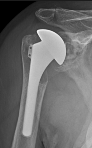 Shoulder Arthritis / Rotator Cuff Tears / Shoulder Pain ...
