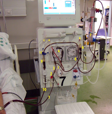Diálisis, diario para principiantes: Hemodiálisis:La linea arterial y ...