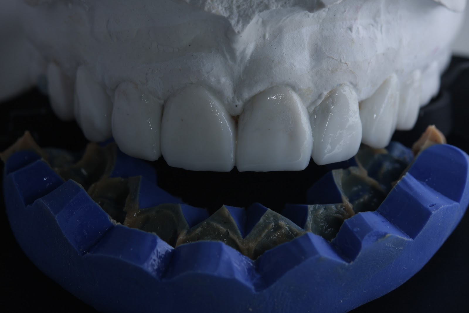 Enceramento diagnóstico, digital smile design e mock up dental, o que ...