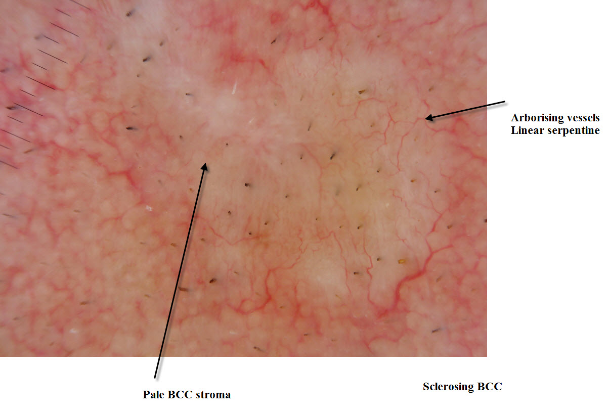 Dermpath Made Simple - Neoplastic: Basal Cell Carcinoma