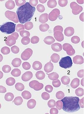 [Haematology] Abnormalities of the White Cell Series | Free Medical Atlas