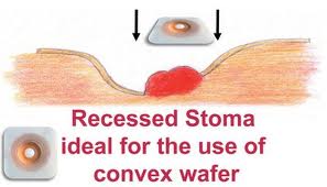 Colostomy Friends of the Philippines: Recessed Stoma