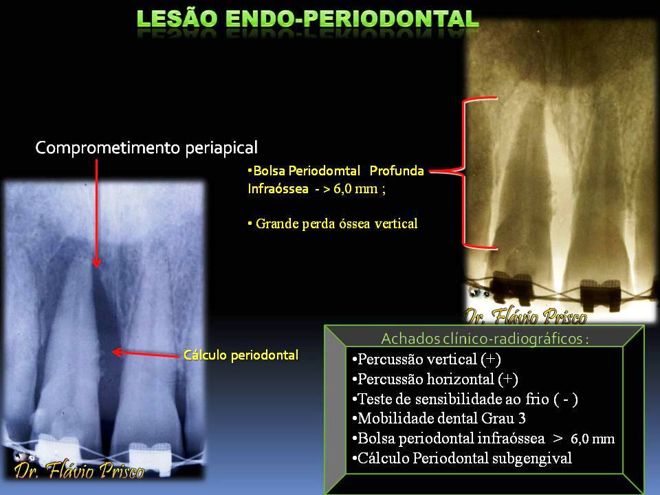 Descobrindo e explorando a Endodontia : Lesão Endo-periodontal