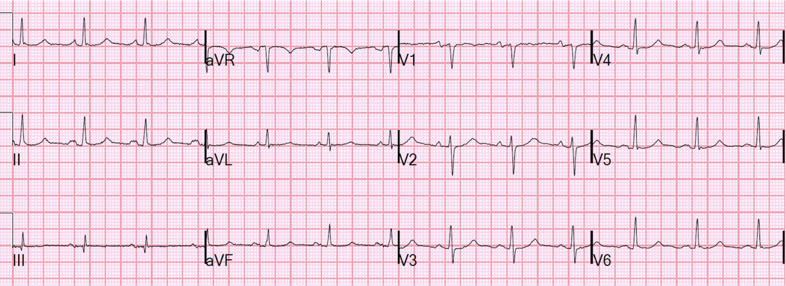 Dr. Smith's ECG Blog: Cardiac arrest, defibrillated, diffuse ST ...