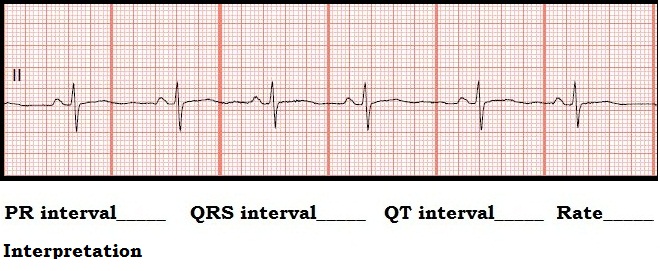 ECG Rhythm Strip Quiz 91: Interval measurements