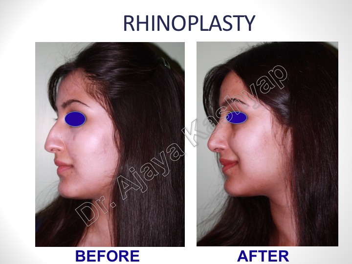Rhinoplasty in India
