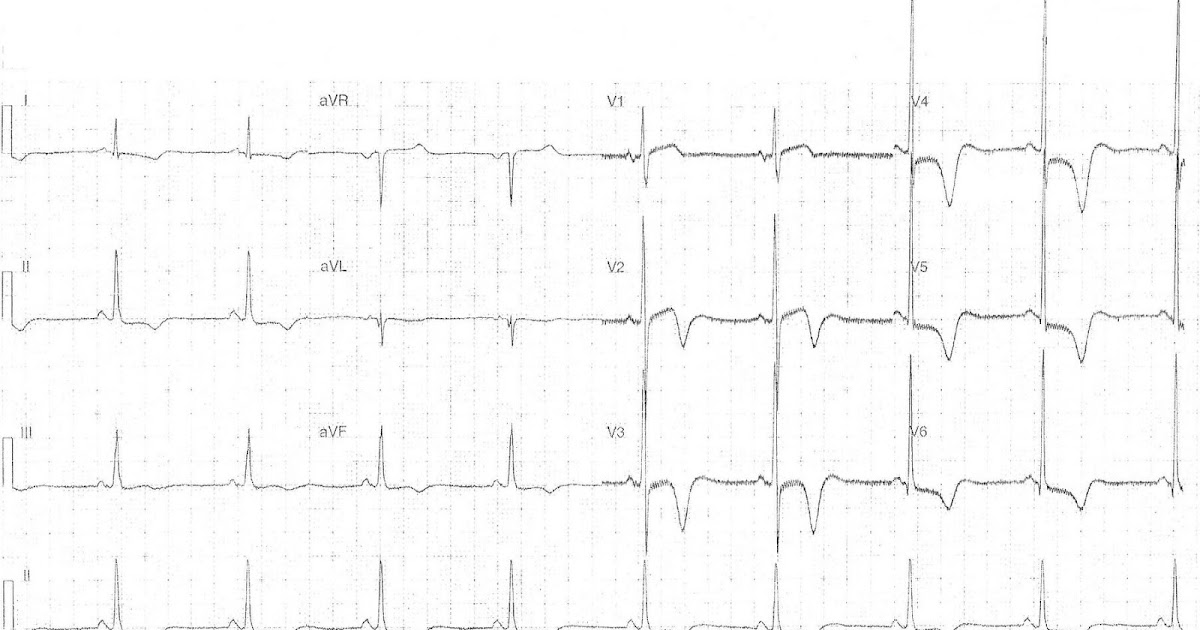 ECG of the Week: ECG of the Week - 3rd April 2017 - Interpretation