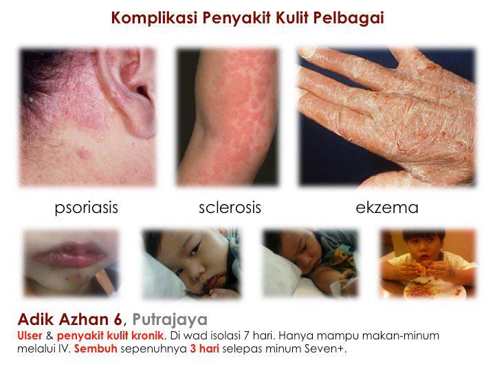 azizshoppe: EXFUZE1 : TESTIMONI PESAKIT KULIT PSORIASIS, SCLEROSIS DAN ...
