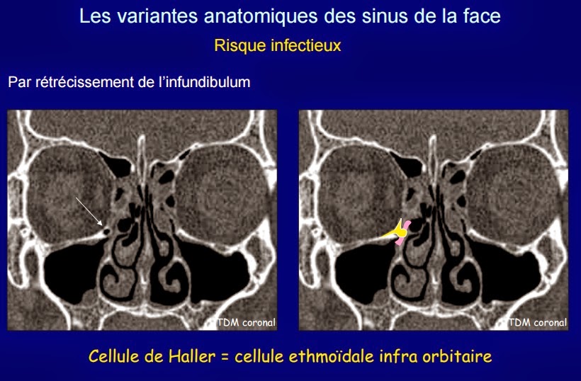 Ma bibliothèque en Imagerie Médicale: VARIANTES ANATOMIQUES DES SINUS