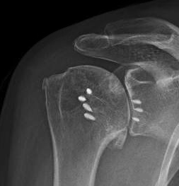 UW Shoulder and Elbow Academy: Total shoulder for anchor arthropathy