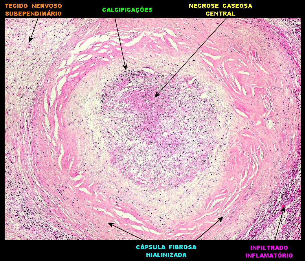 necrose caseosa - wood scribd braxin