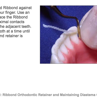 Dental Mart: Ribbond Ribbon Orthodontics 1mm