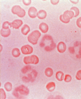 Leukemoid Reaction (LR)