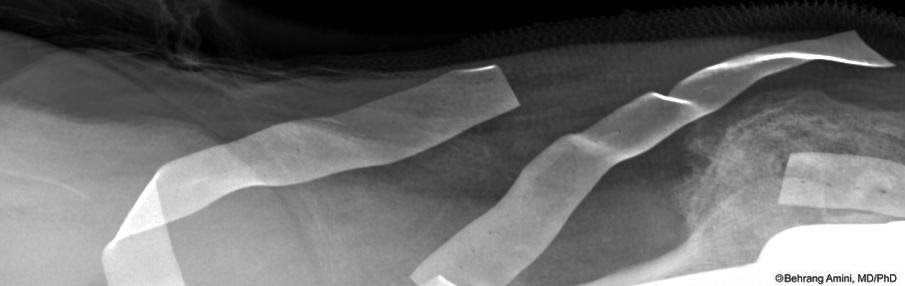Roentgen Ray Reader: Laparotomy Sponge on Radiographs
