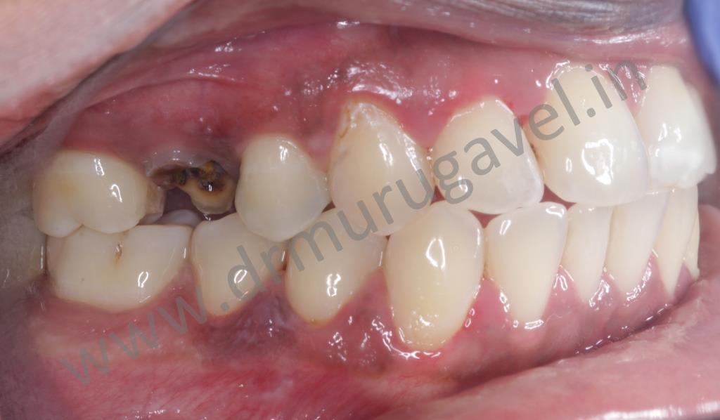 Severe decayed tooth extraction and immediate dental implants in chennai