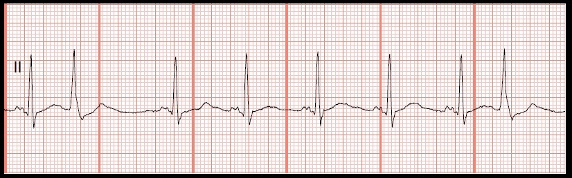 EKG Rhythm Strip Quiz 168
