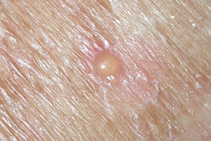 Uroda. Zdrowie. Moda. Nauka. Dieta.: Schorzenia skóry i tkanki ...