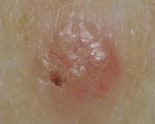 Pictures of skin cancer: Squamous cell skin cancer pictures