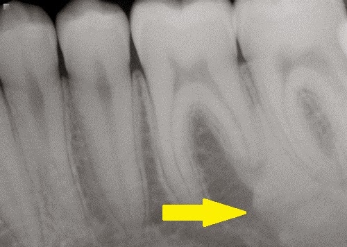 :: World Of Dentistry ::: Idiopathic Osteosclerosis