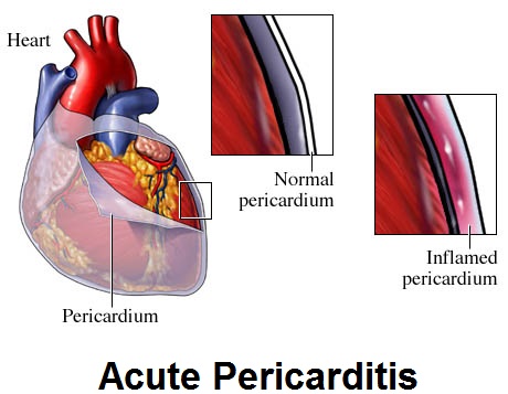 Prepare for Medical Exams : Acute Pericarditis and Cardiac Tamponade