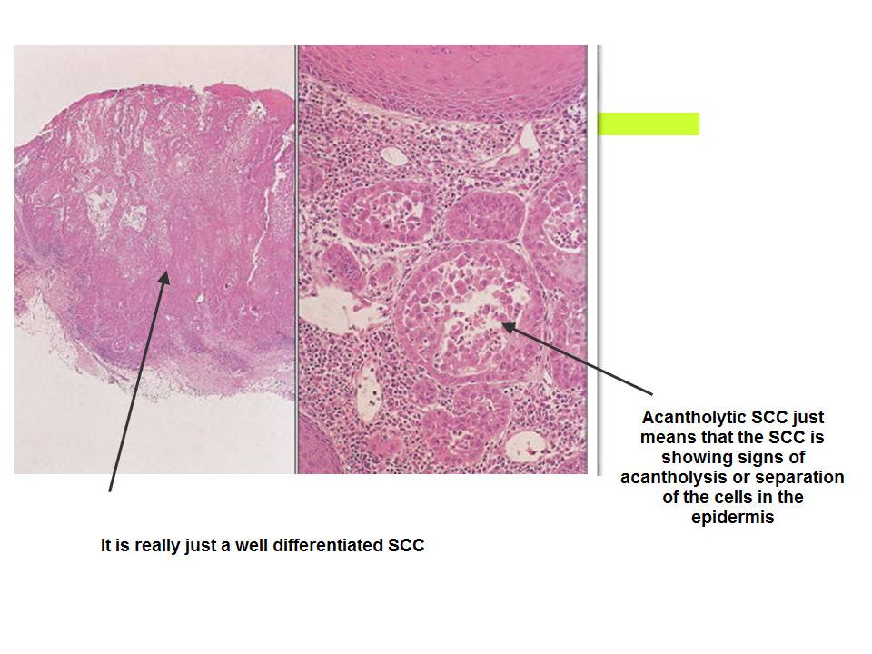 Dermpath Made Simple - Neoplastic: Squamous cell Carcinoma