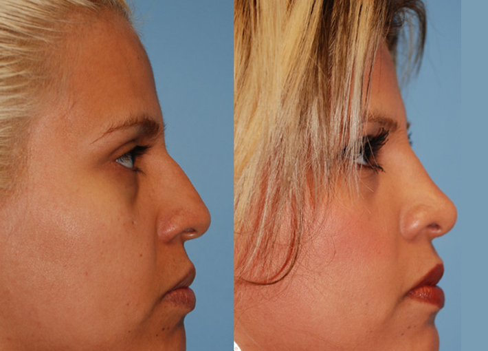 Burun Estetiği resimleri