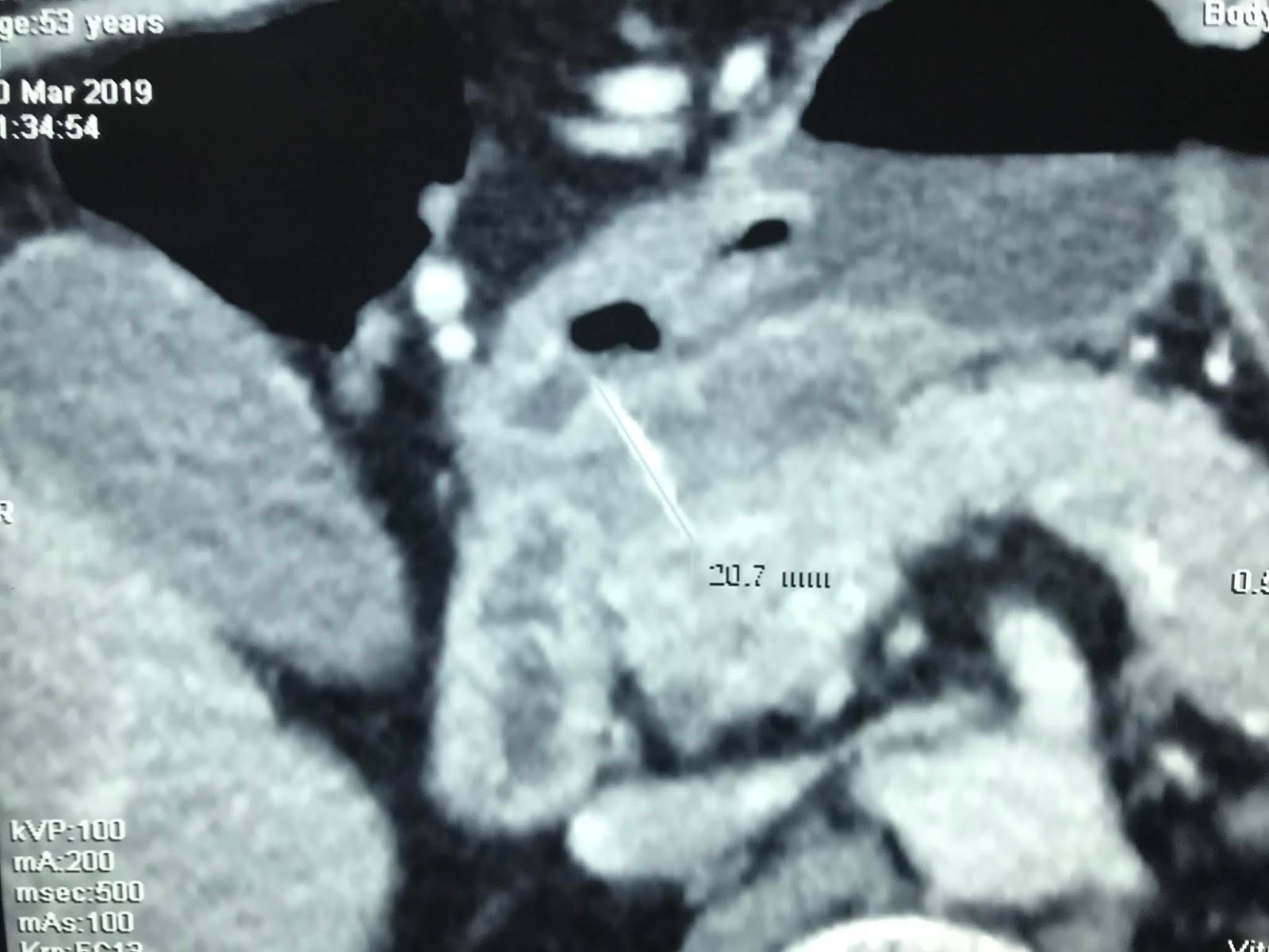 VIETNAMESE MEDIC ULTRASOUND: CASE 544: GASTRIC PERFORATION DUE TO ...