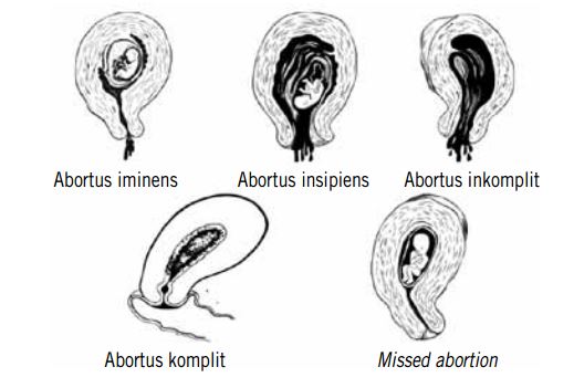 Macam-Macam Abortus ~ Gita Midwifery