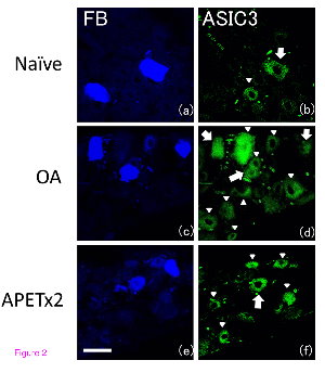 Neuromics: ASIC3 and Osteoarthritis