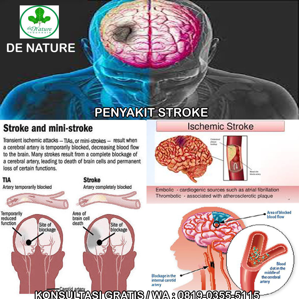 Obat stroke paling ampuh dan aman rekomendasi dokter - cara terapi ...