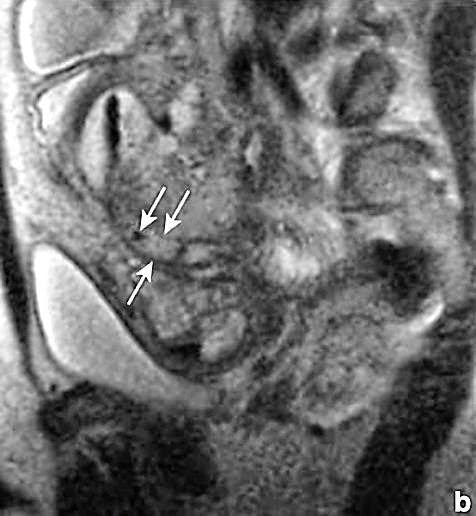 DR. JUAN HERNÁNDEZ ORDUÑA. : Casos especiales en apendicitis aguda texto